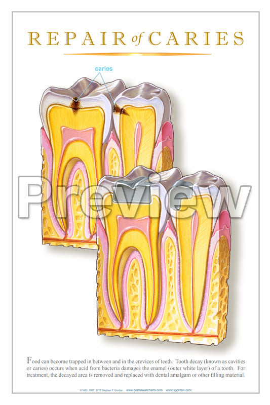Repair of Caries Wall Chart – Dental Flip Charts by Stephen F. Gordon