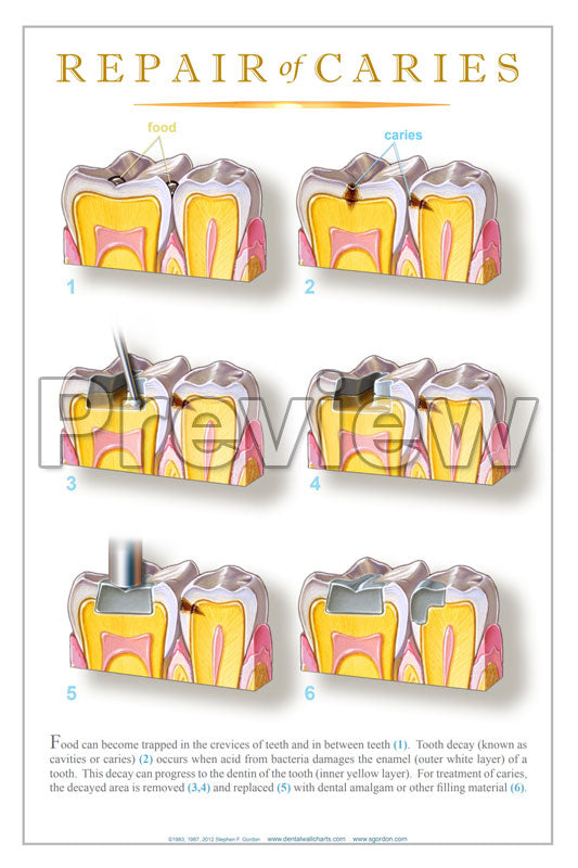 Repair of Caries #3 Wall Chart – Dental Flip Charts by Stephen F. Gordon